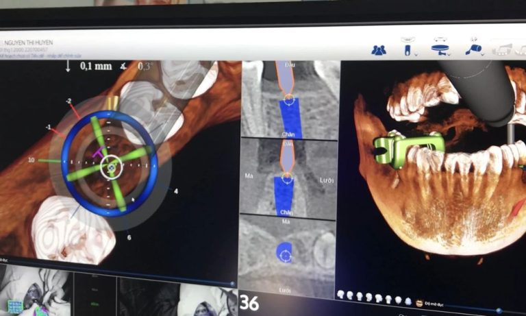 Công nghệ định vị phẫu thuật Navident - Phương pháp cấy Implant không đau